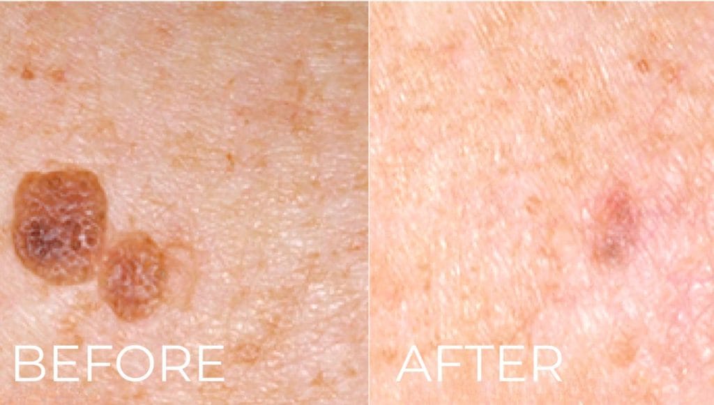 CryoPen at Cedar Therapy | Non-Invasive Skin Lesion
