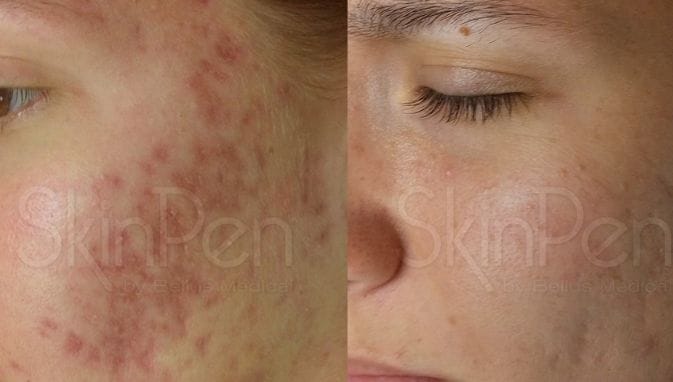 SkinPen Advanced Microneedling - Cedar Therapy
